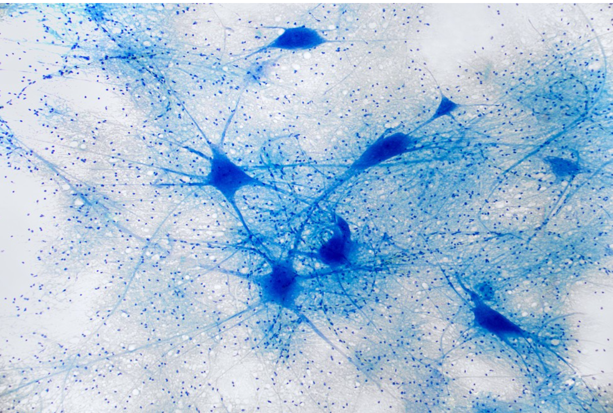 ‘New’ ALS gene destabilizes neuron’s structure and chokes off its ...